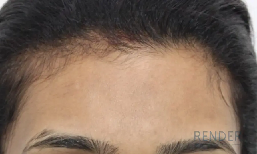 Pigmentation - Best Skin and Hair Clinic In Chennai - Render Clinic