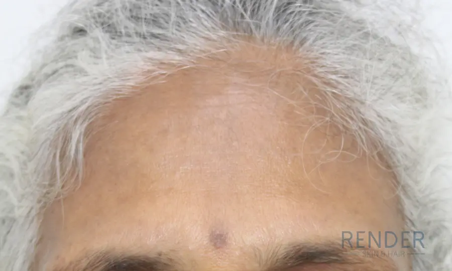 Pigmentation - Best Skin and Hair Clinic In Chennai - Render Clinic