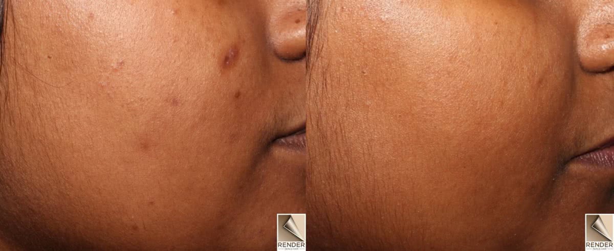 Chosen's B&A - Best Skin and Hair Clinic In Chennai - Render Clinic